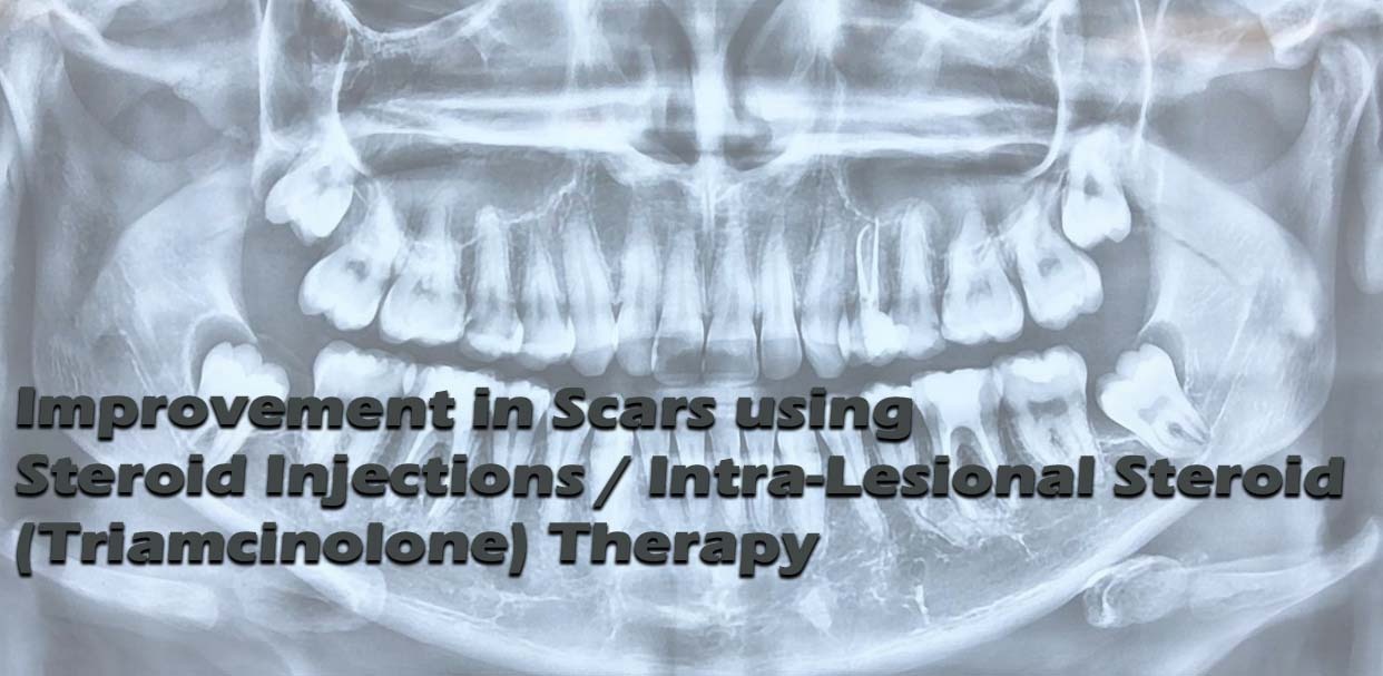 Hegab Academt-Steroid Injections Into Scars